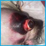 Proptose Ocular - CLOVE